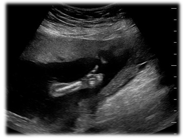 Third Trimester Assessment - Sonosession
