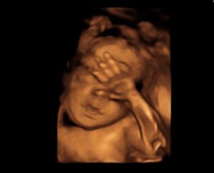 Ultrasound in the Third Trimester - Sonosession