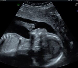 Routine Growth + Anatomy Scan - Sonosession