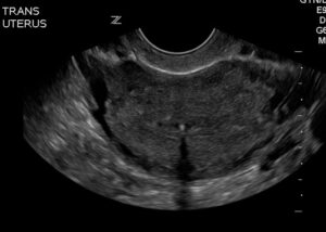 Confirming IUD Placement - Sonosession