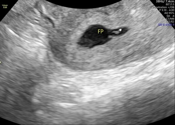 5 Weeks Gestation: What Should I See? - Sonosession