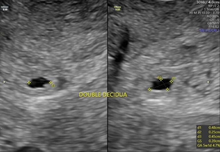 5 Weeks Gestation: What Should I See? - Sonosession