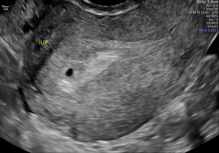 5 Weeks Gestation: What Should I See? - Sonosession
