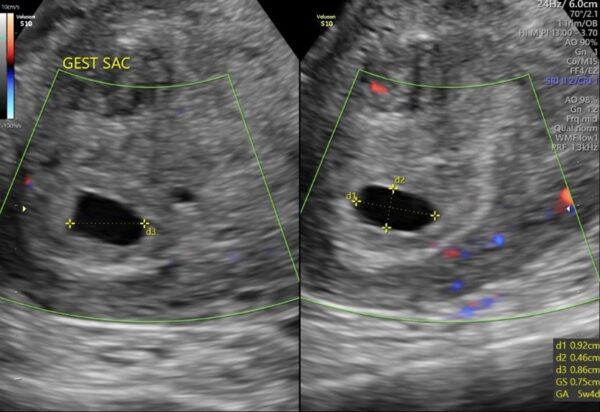 5 Weeks Gestation: What Should I See? - Sonosession