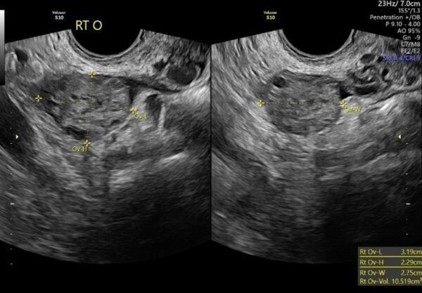 5 Weeks Gestation: What Should I See? - Sonosession