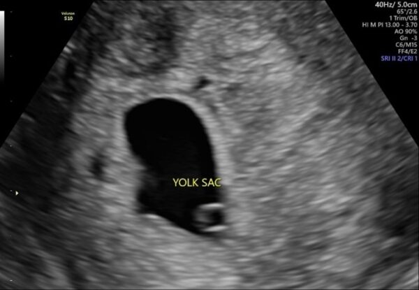 5 Weeks Gestation: What Should I See? - Sonosession