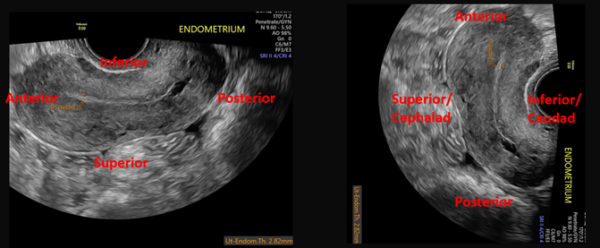 Nine Week Gestation with Retroverted uterus – Well, this is confusing ...