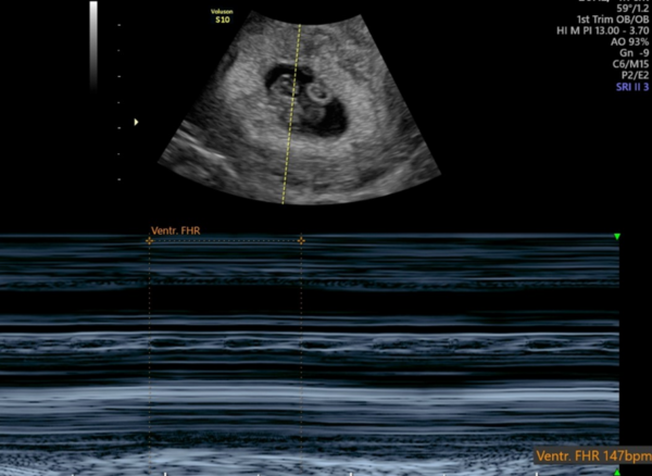 First Trimester Foundation: The 5 A's - Sonosession