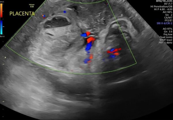 Placental Abruption - Sonosession