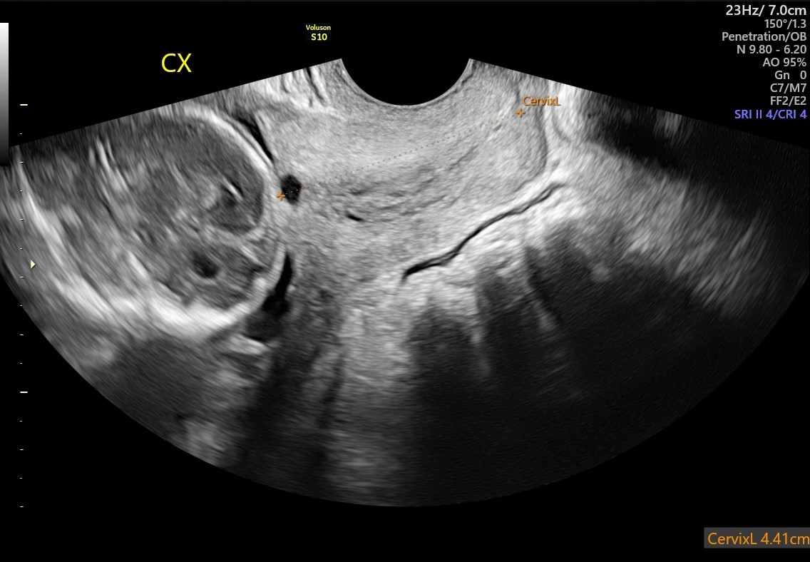 September Lunch + Learn: The Cervix - Sonosession September Lunch + Learn: The Cervix - Sonosession
