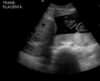 Marginal Placenta Previa - Sonosession