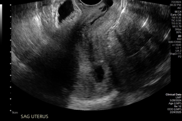 First Trimester Cervical Funneling: Rare Case Study