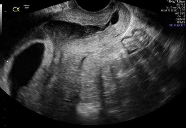 First Trimester Cervical Funneling: Rare Case Study