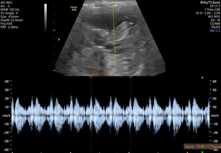 First Trimester Cervical Funneling: Rare Case Study