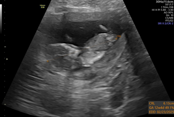First Trimester Cervical Funneling: Rare Case Study