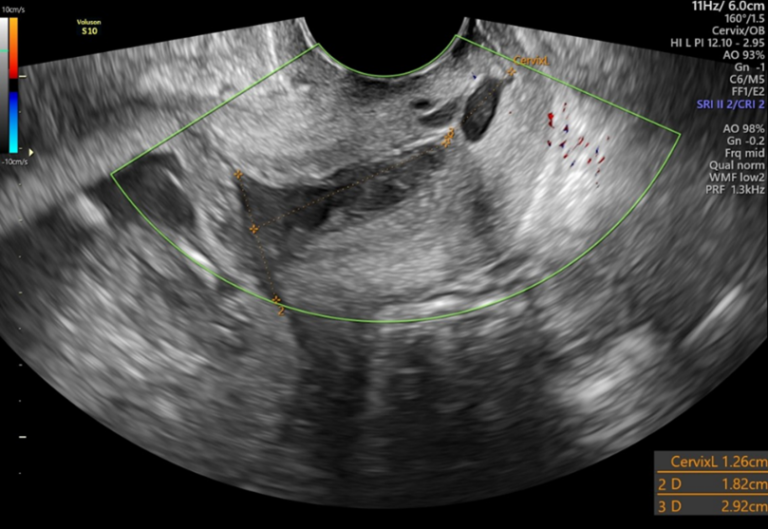 First Trimester Cervical Funneling: Rare Case Study