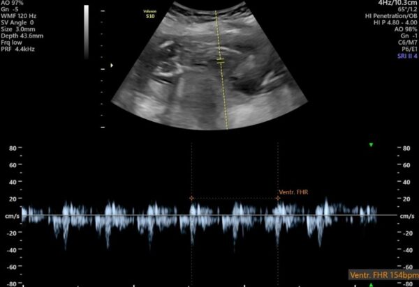 First Trimester Cervical Funneling: Rare Case Study