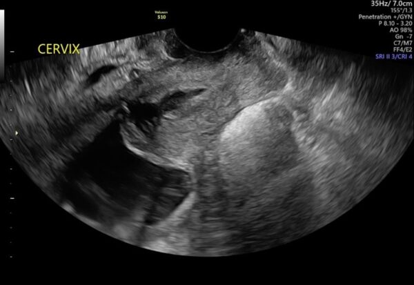 First Trimester Cervical Funneling: Rare Case Study