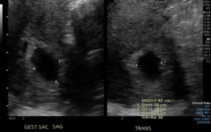 First Trimester Cervical Funneling: Rare Case Study