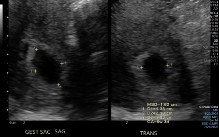 First Trimester Cervical Funneling: Rare Case Study