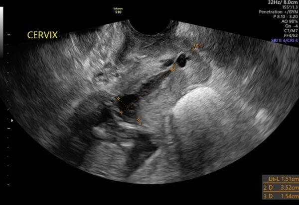 First Trimester Cervical Funneling: Rare Case Study