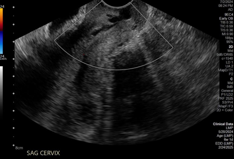 First Trimester Cervical Funneling: Rare Case Study