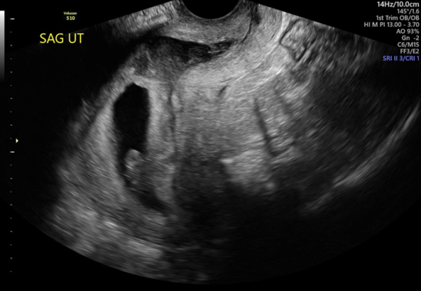 First Trimester Cervical Funneling: Rare Case Study