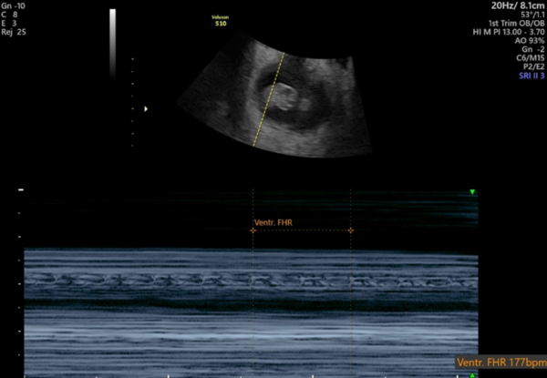 First Trimester Cervical Funneling: Rare Case Study