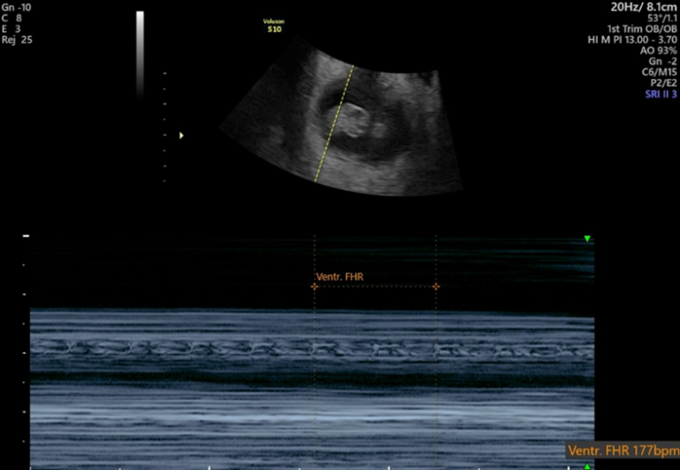 First Trimester Cervical Funneling: Rare Case Study