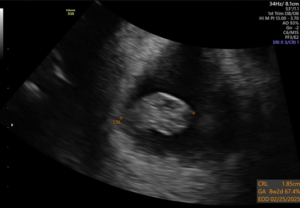 First Trimester Cervical Funneling: Rare Case Study