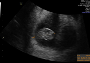 First Trimester Cervical Funneling: Rare Case Study