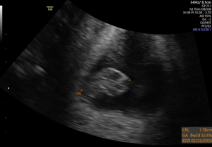First Trimester Cervical Funneling: Rare Case Study