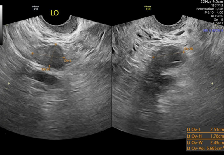 First Trimester Cervical Funneling: Rare Case Study