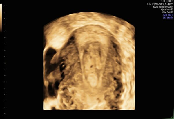 Retained Products of Conception (RPOC) - Sonosession