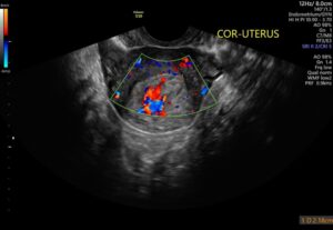 Retained Products of Conception (RPOC) - Sonosession