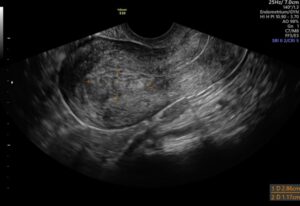 Retained Products of Conception (RPOC) - Sonosession