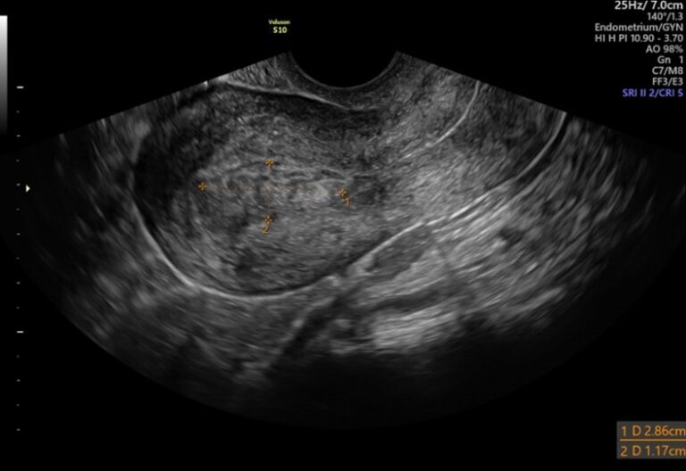 Retained Products of Conception (RPOC) - Sonosession