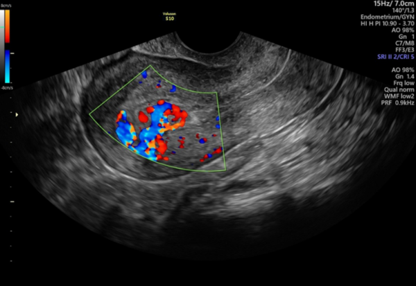 Retained Products of Conception (RPOC) - Sonosession