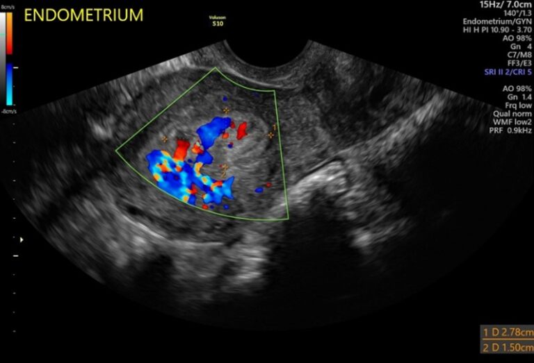 Retained Products of Conception (RPOC) - Sonosession