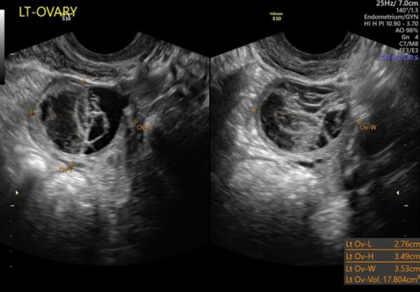 Retained Products of Conception (RPOC) - Sonosession
