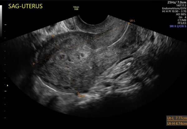 Retained Products of Conception (RPOC) - Sonosession