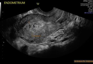 Retained Products of Conception (RPOC) - Sonosession