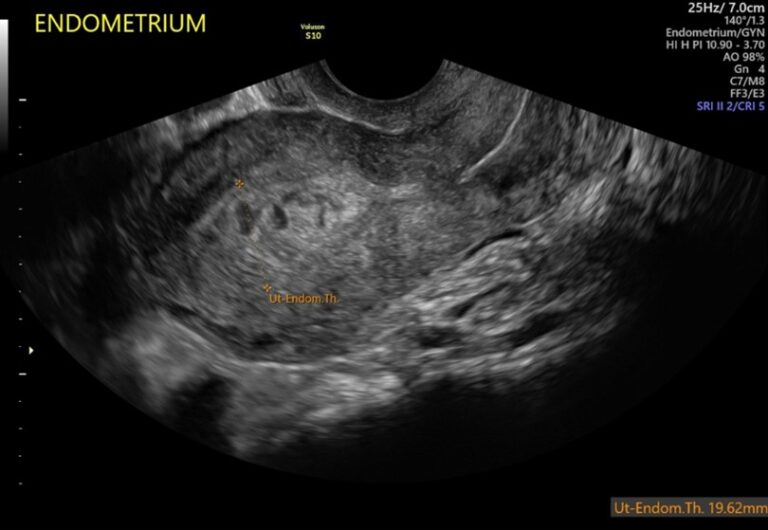 Retained Products of Conception (RPOC) - Sonosession