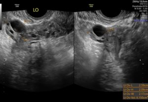 Retained Products of Conception (RPOC) - Sonosession
