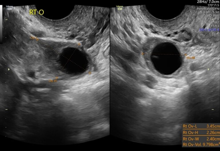 Retained Products of Conception (RPOC) - Sonosession