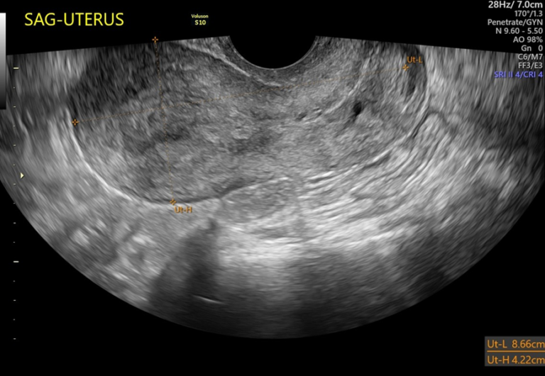 Retained Products of Conception (RPOC) - Sonosession
