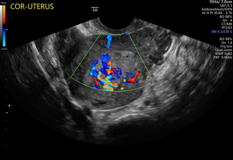 Retained Products of Conception (RPOC) - Sonosession