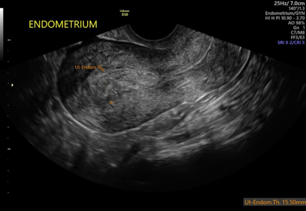 Retained Products of Conception (RPOC) - Sonosession