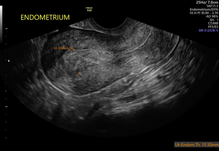 Retained Products of Conception (RPOC) - Sonosession