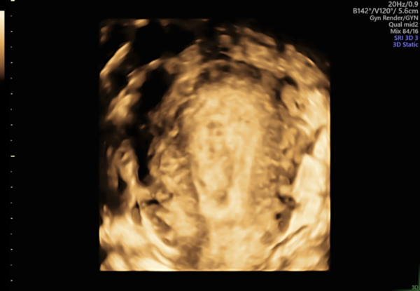 Retained Products of Conception (RPOC) - Sonosession